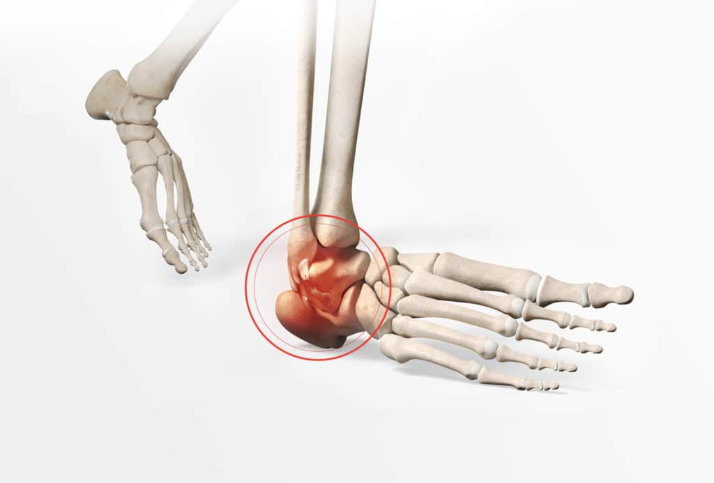 Définition, symptômes et diagnostic de l'entorse de cheville | Dr Paillard