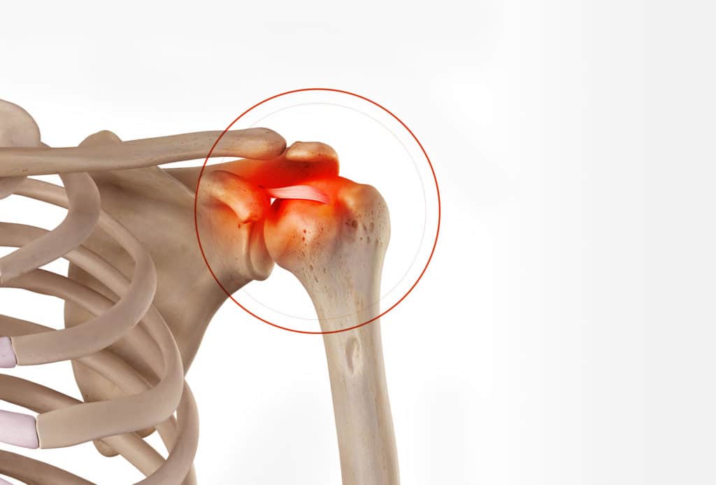 Acromioclavicular stabilization | Doctor Philippe Paillard Office