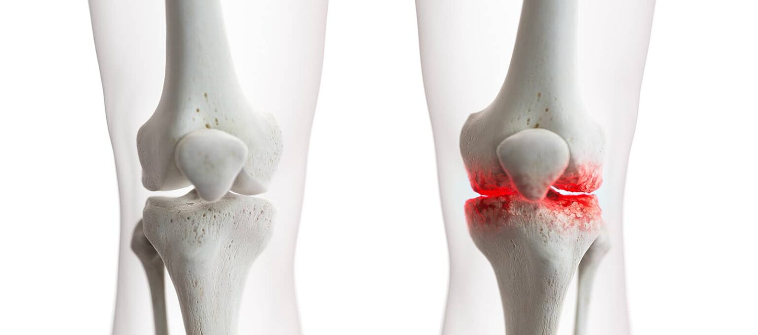 Comment savoir si on a un problème au genou ? | Dr Paillard