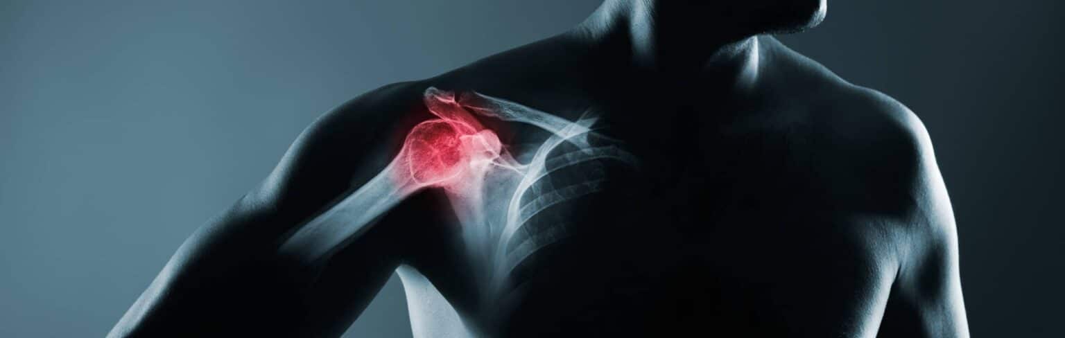 Quels sont les différents types de pathologie de l'épaule ? | Dr ...